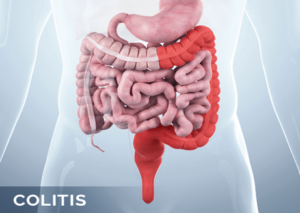 Inflammatory Bowel Disease: signs, symptoms, causes, and diagnosis ...