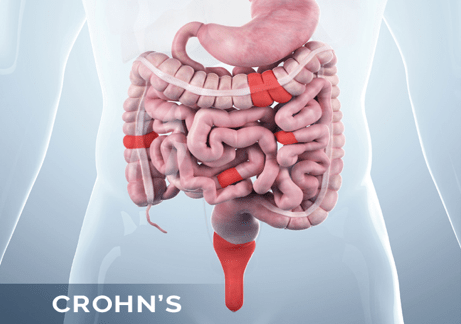Inflammatory Bowel Disease: signs, symptoms, causes, and diagnosis ...